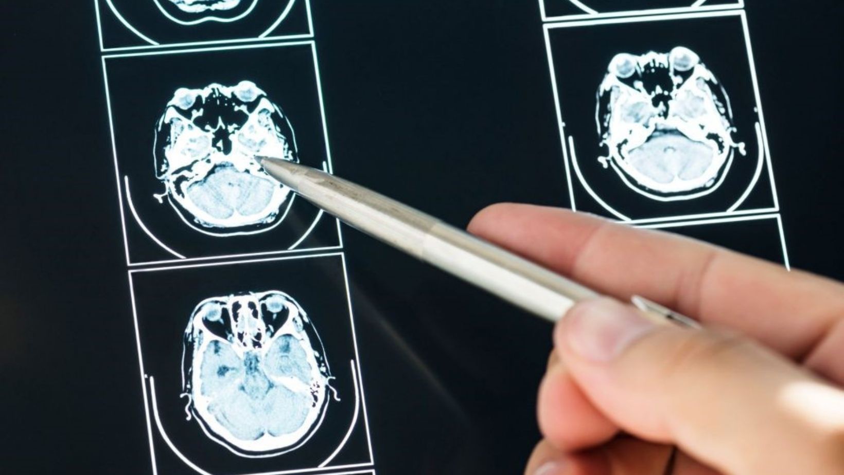 Coma: A Life-Changing Consequence of a Brain Injury - Usefulideas