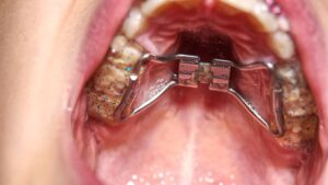 Understanding Narrow Palate: Causes, Symptoms, and Treatment Options ...